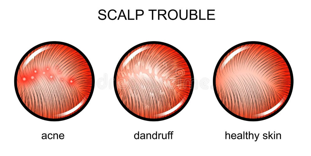Scalp Stock Illustrations – 10,482 Scalp Stock Illustrations, Vectors ...