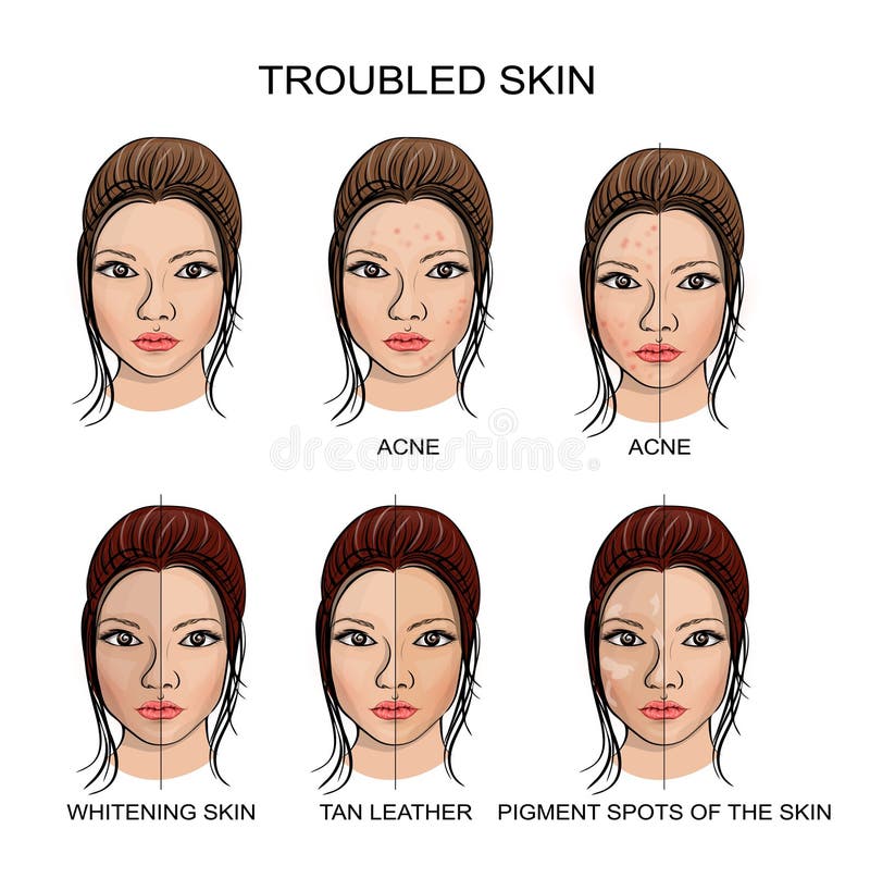 Troubled Skin and Healthy Skin Stock Vector - Illustration of ...