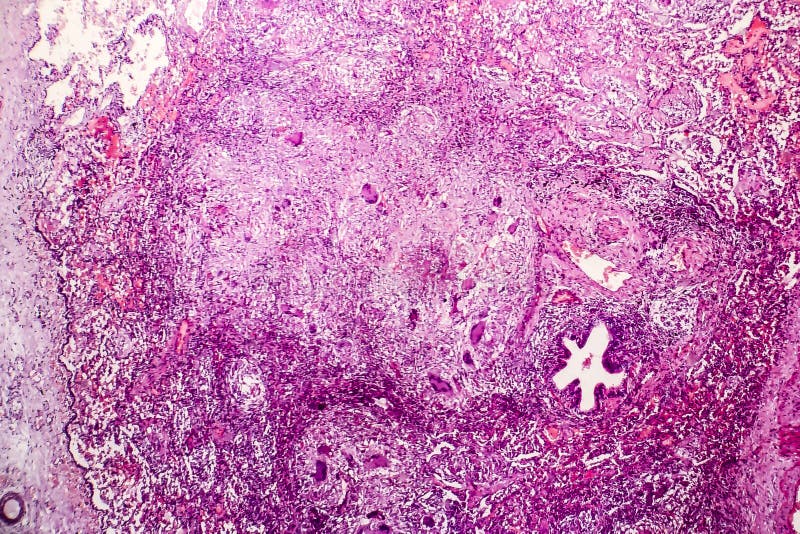 Tubercle, light micrograph stock photo. Image of tubercle - 139741892