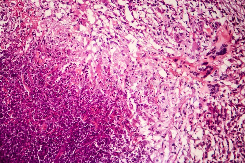 Tubercle, light micrograph stock photo. Image of medicine - 139742316