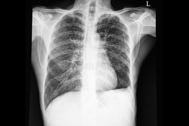 Tubercolosi Miliare, Micrografo Leggero Immagine Stock - Immagine di ...