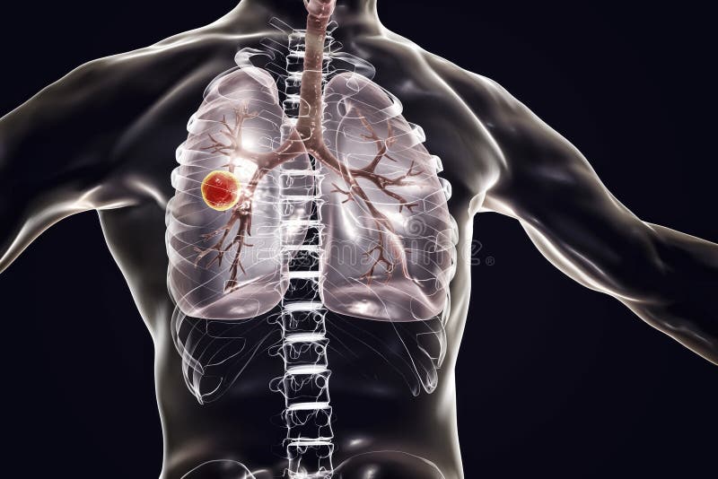 Tuberculose Pulmonaa Fibroso-cavernosa Ilustração Stock - Ilustração de ...