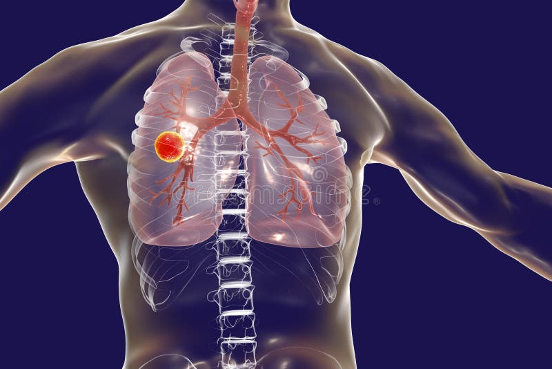 Tuberculose Pulmonaire Fibreux-caverneuse Illustration Stock ...