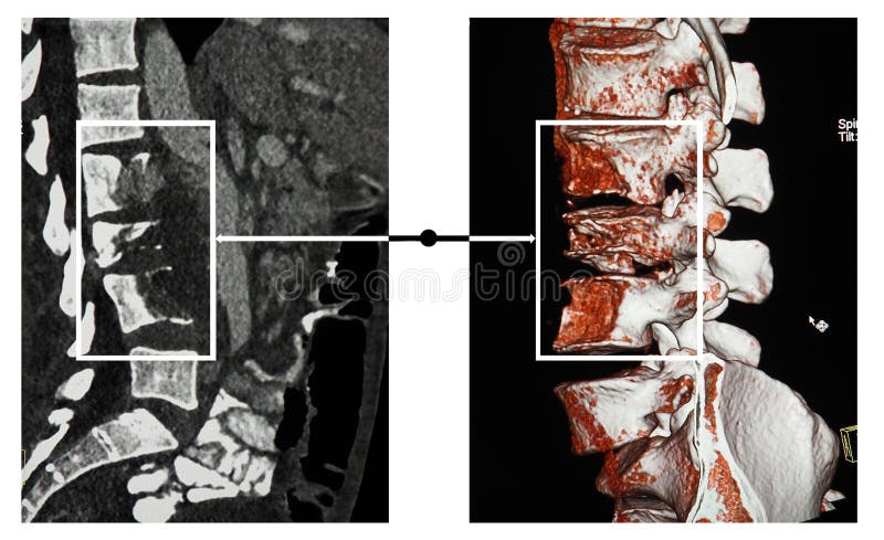 132 Tuberculosis Ct Stock Photos - Free & Royalty-Free Stock Photos ...