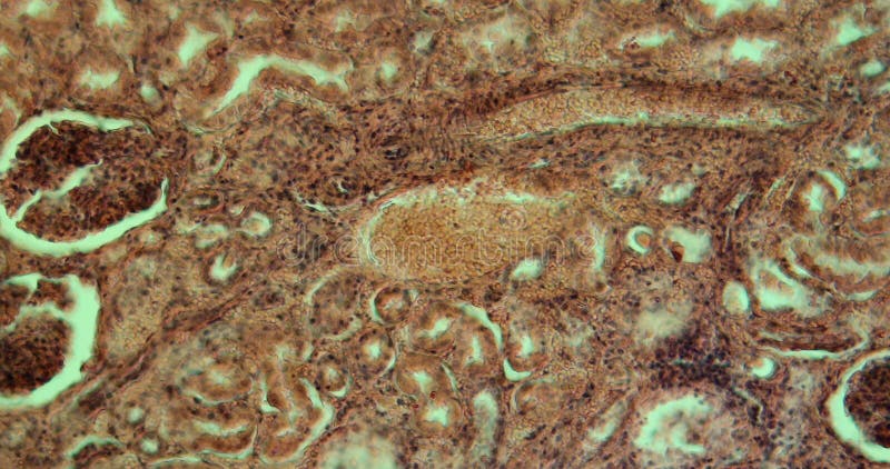 Tuberculosis of the Kidney Tissue Stock Video - Video of kidney, tissue ...