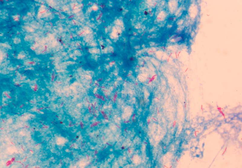 Tuberculosis Micro De La Bacteria Foto de archivo - Imagen de cuidado ...