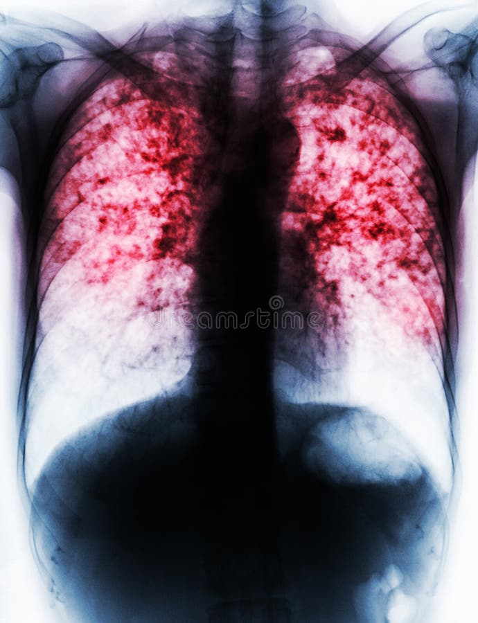 Tuberculosis Pulmonar Miliar Imagen de archivo - Imagen de hueso ...