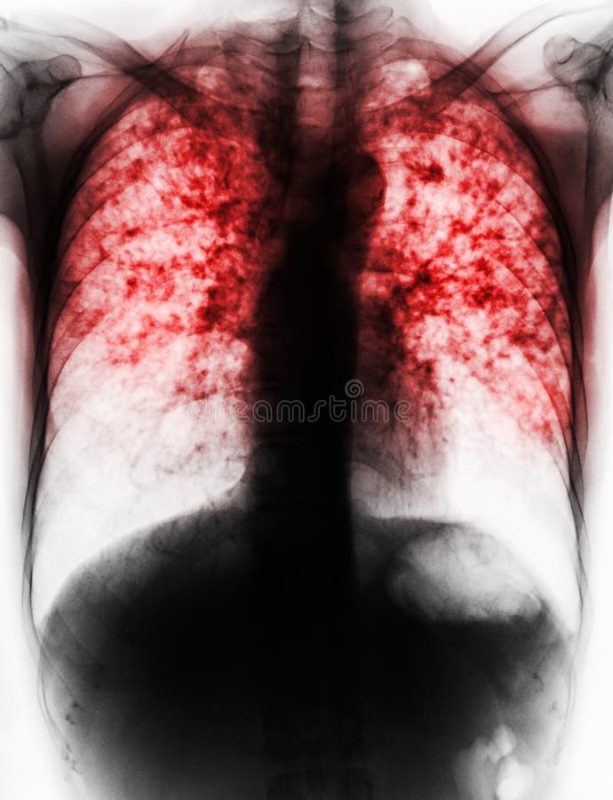 Tuberculosis pulmonar foto de archivo. Imagen de costilla - 96171490