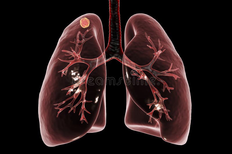 Tuberculosis Secundaria En Pulmones Y La Opinión Del Primer Las ...