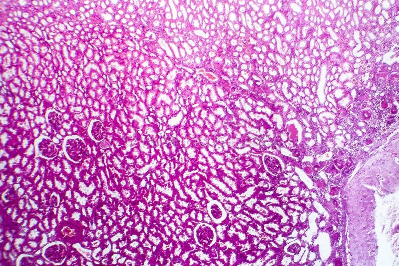 Tubular Atrophy, Light Micrograph Stock Photo - Image of renal ...
