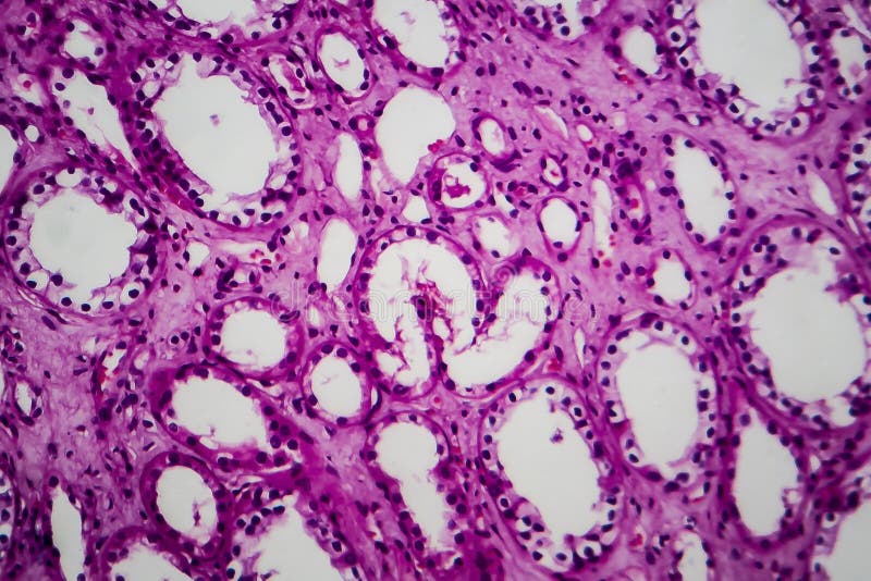 Tubular Atrophy, Light Micrograph Stock Photo - Image of ...