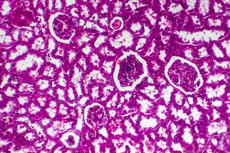 Tubular Atrophy, Light Micrograph Stock Photo - Image of renal ...