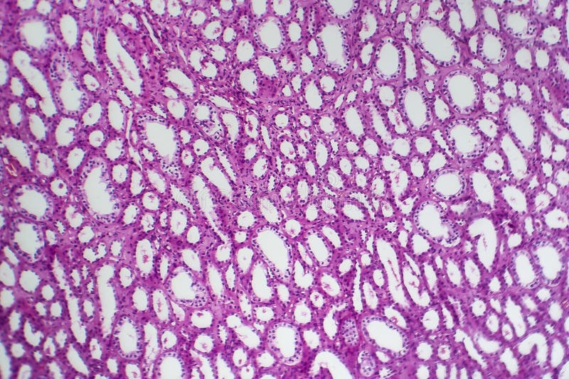 Tubular Atrophy, Light Micrograph Stock Photo - Image of micrograph ...