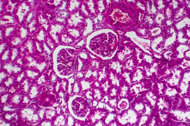 Tubular Atrophy, Light Micrograph Stock Photo - Image of histology ...