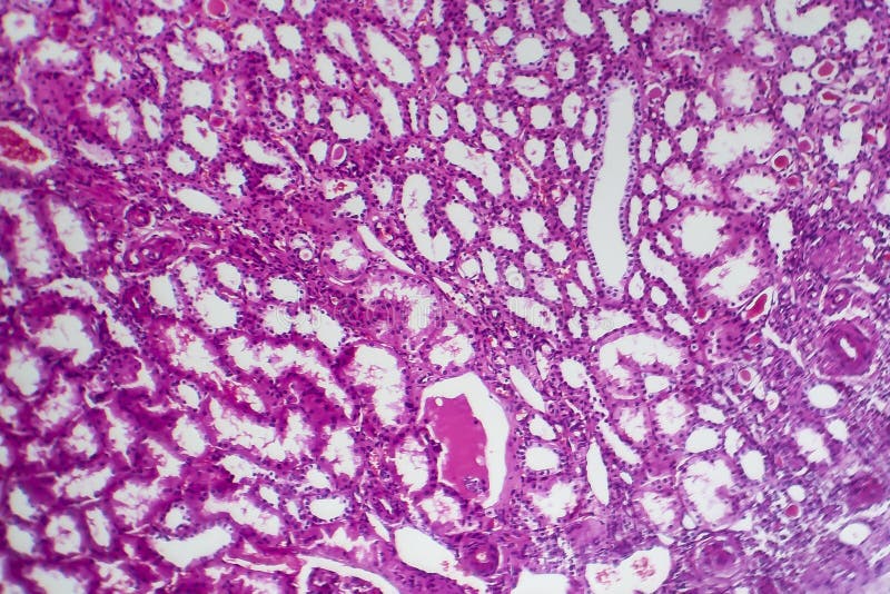 Tubular Atrophy, Light Micrograph Stock Image - Image of tissue ...