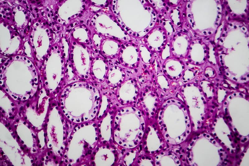 Tubular Atrophy, Light Micrograph Stock Photo - Image of renal ...