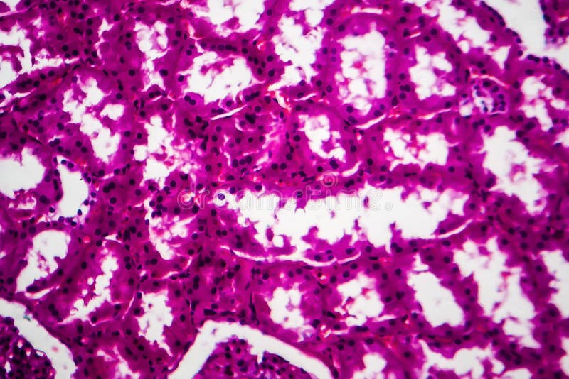 Tubular Atrophy, Light Micrograph Stock Image - Image of fibrosis ...