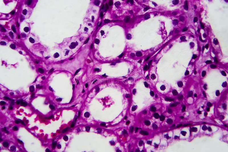 Tubular Atrophy, Light Micrograph Stock Photo - Image of pathology ...