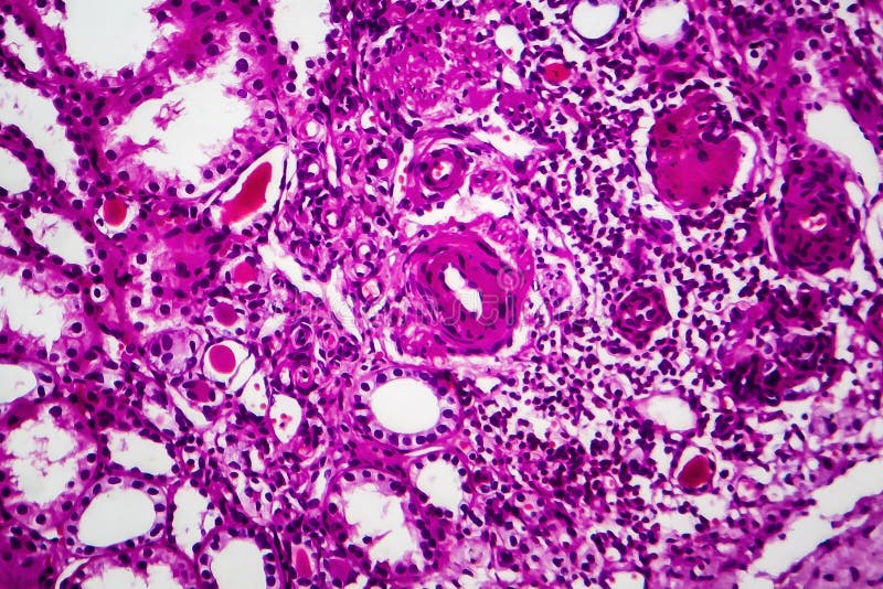 Tubular Atrophy, Light Micrograph Stock Photo - Image of renal ...