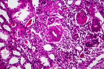 Tubular Atrophy, Light Micrograph Stock Photo - Image of renal ...