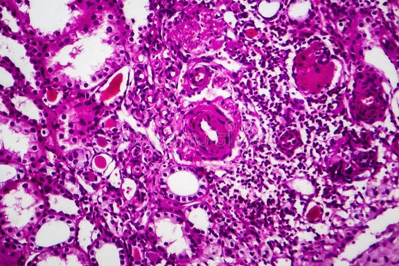 Tubular Atrophy, Light Micrograph Stock Photo - Image of renal ...