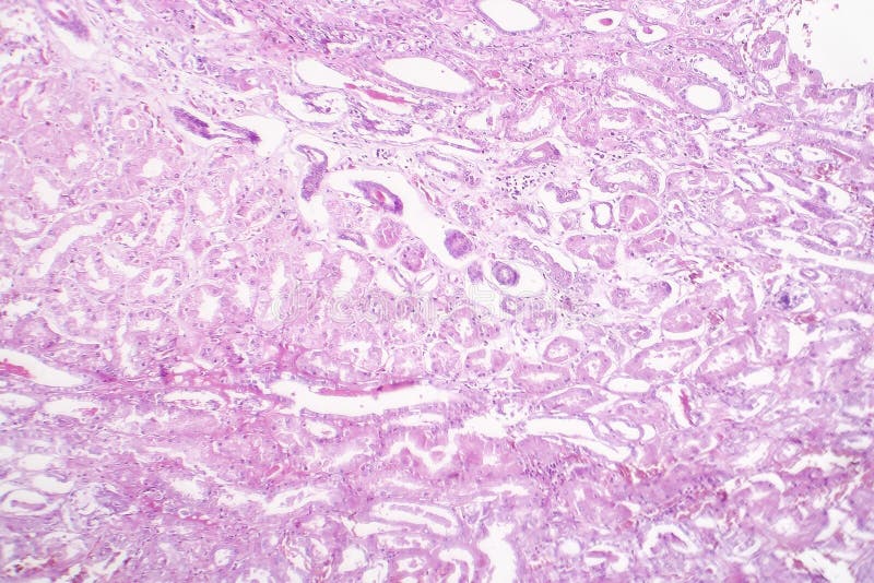 Tubular epithelial edema stock photo. Image of edema - 121506496