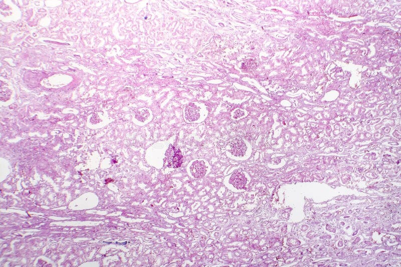 Tubular epithelial edema stock photo. Image of microscope - 121505972