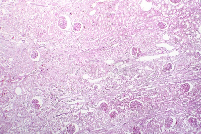 Edema of Renal Tubular Epithelial Cells in Kidney Failure Stock Photo ...