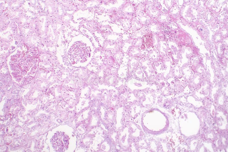 Tubular epithelial edema stock image. Image of histopathology - 121506583