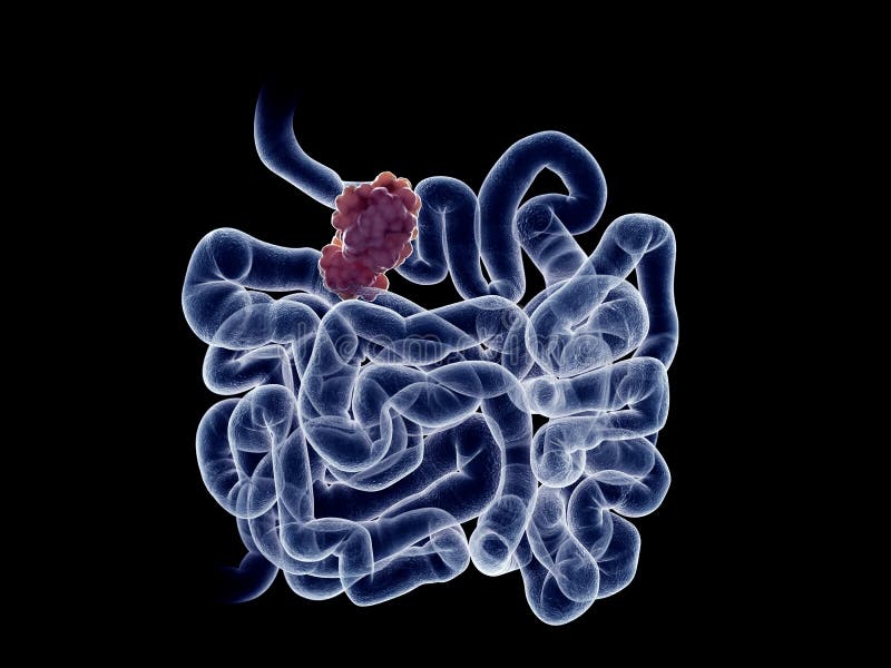 Tumor Del Intestino Delgado Stock de ilustración - Ilustración de ...
