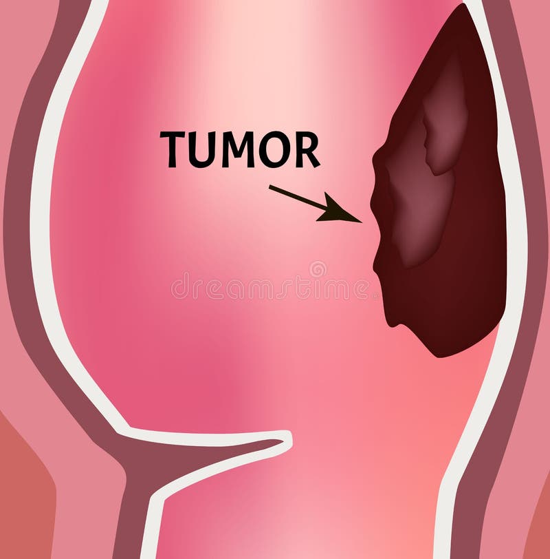 Two Types of Hemorrhoids. Internal and External Hemorrhoidal Stock ...