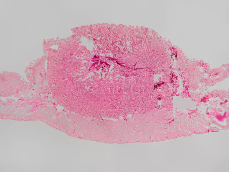 Tumore cancroide 10X fotografia stock. Immagine di medico - 17115148