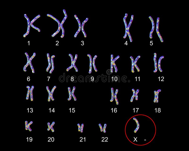 Turner S-syndrome Karyotype Stock Illustration - Illustration of ...