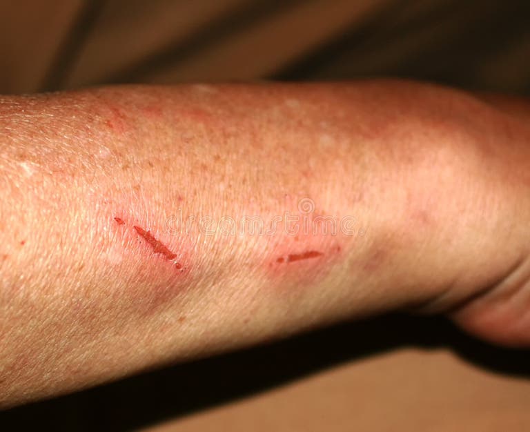 Two Cuts on the Arm. Wound on Hand. Stock Image - Image of armpit ...