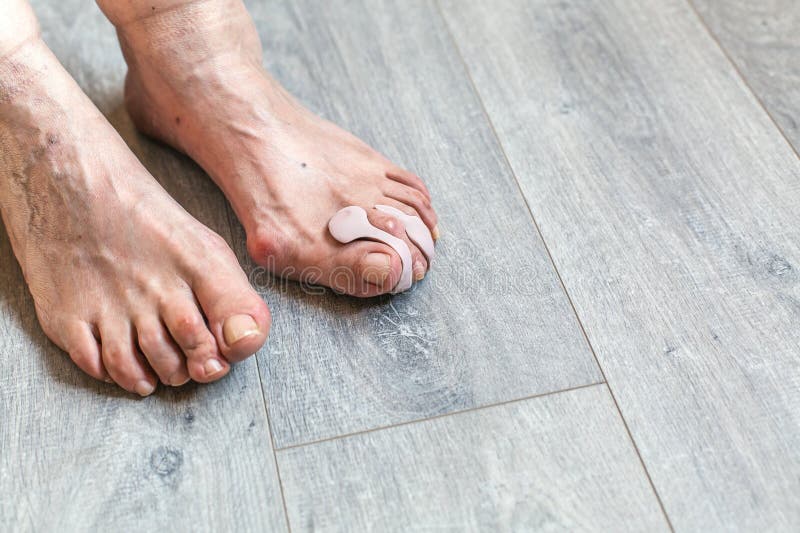 Two Feet with Bunions and Visible Toe Deformities, One Wearing a Soft ...