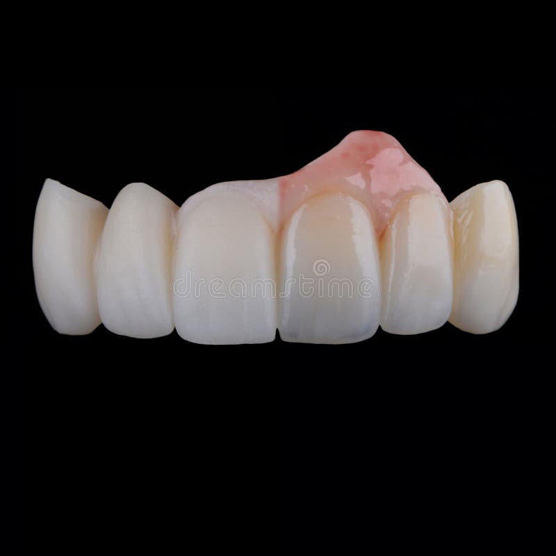 Two Halves before and after Staining of a Monolithic Dental Bridge with ...
