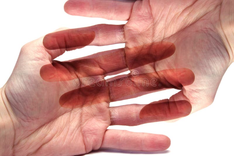 Deformed hands stock photo. Image of people, medical - 16211826