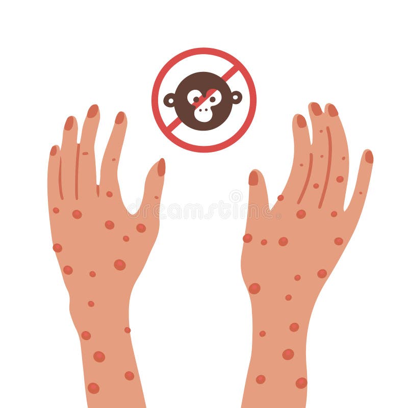 Two Hands with Monkeypox Virus Rashes. Stop New Infection. Vector Flat ...