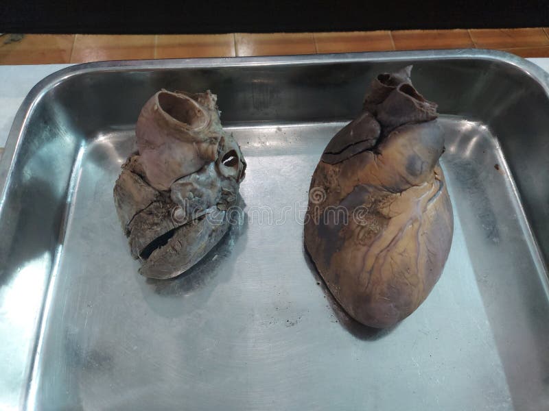 A Medical Tray Containing Various Syringes, Vials, and a Surgical ...