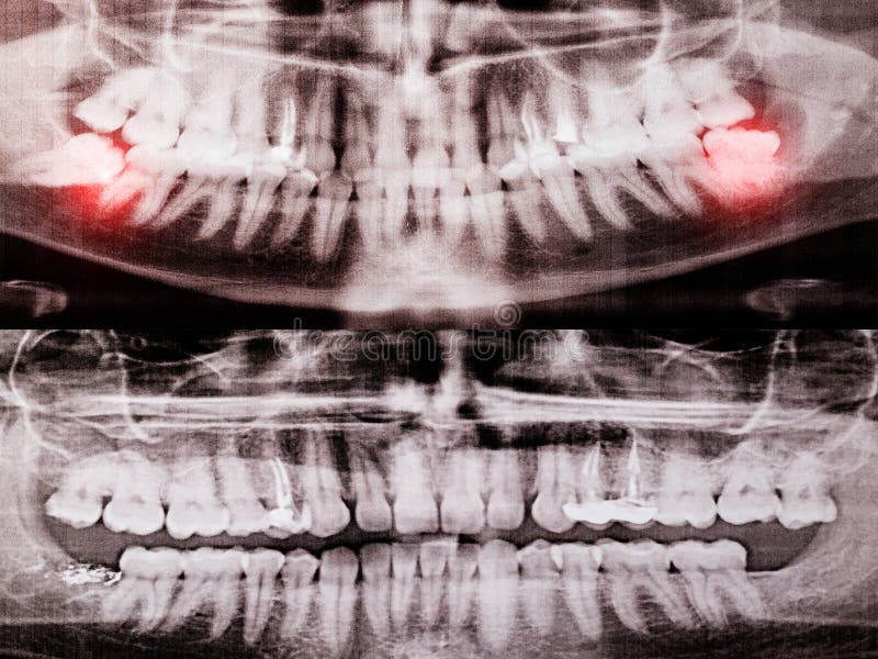 Two Panoramic X-rays of Lower Wisdom Teeth and Removed Wisdom Teeth ...