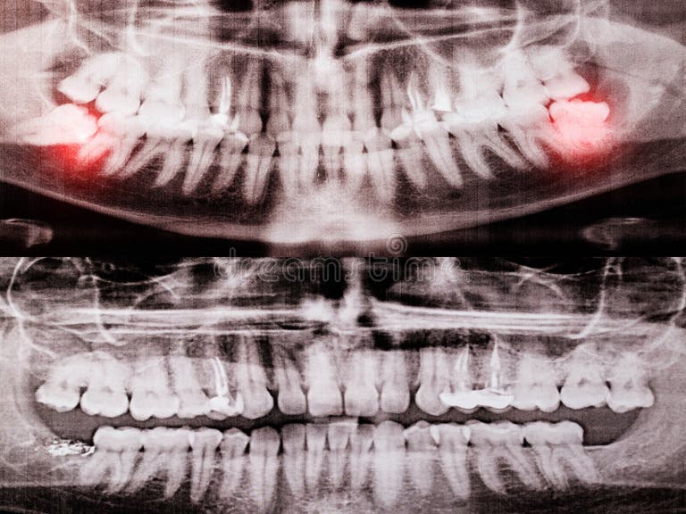 Two Panoramic X-rays of Lower Wisdom Teeth and Removed Wisdom Teeth ...