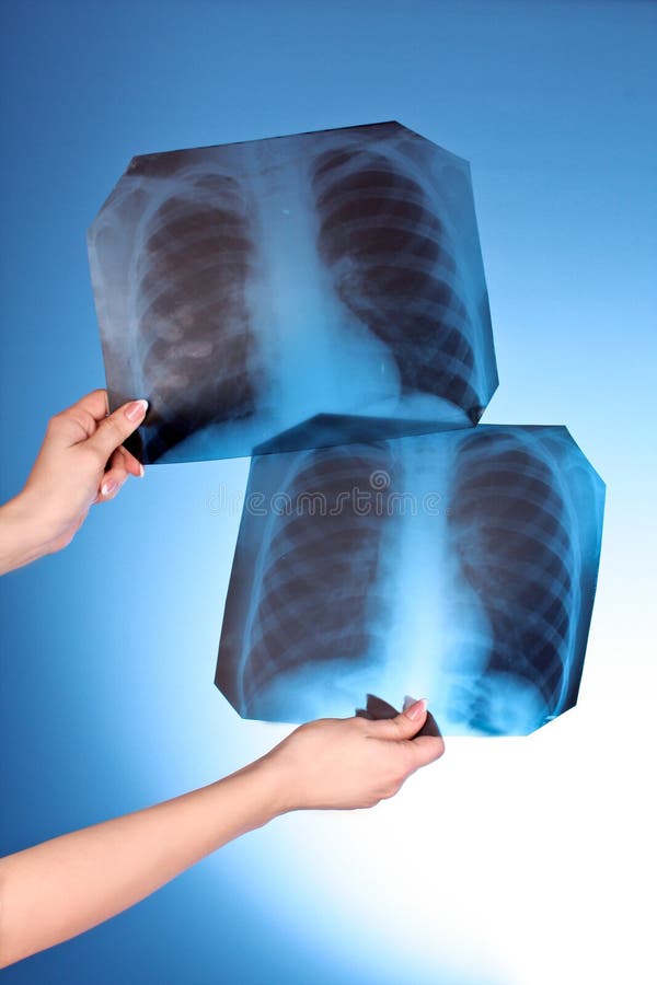 Two X-Ray Images of Chest on Blue Background Stock Image - Image of ...