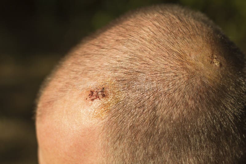 Two Scars after Removing Fat Tissue from Head Stock Image - Image of ...