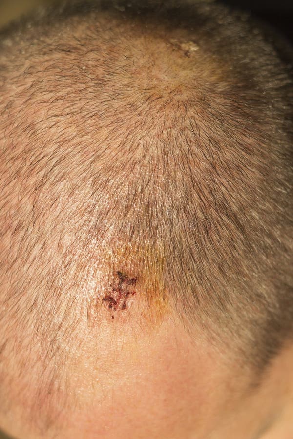 Two Scars after Removing Fat Tissue from Head Stock Image - Image of ...
