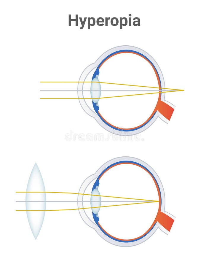 Hyperopia, Farsightedness Eye Disorder, and Corrected Eye by a Plus ...