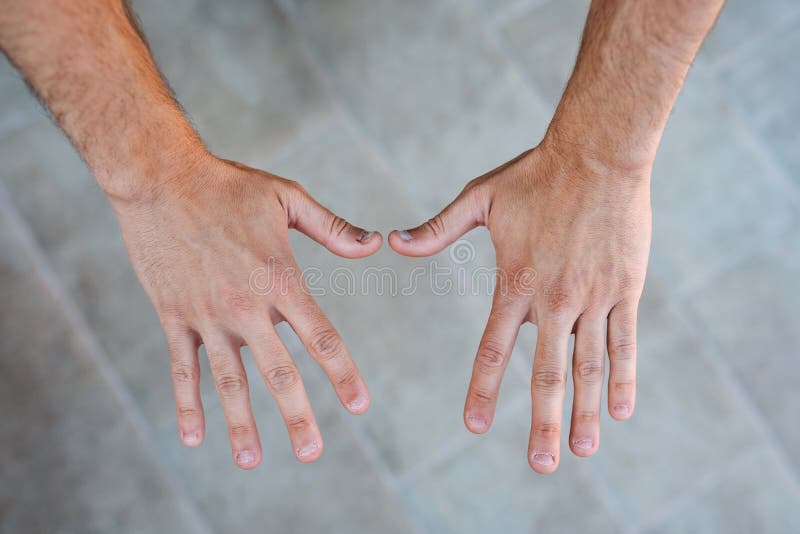 Two Young Man Hands with Ugly and Bitten Fingernails Stock Image ...