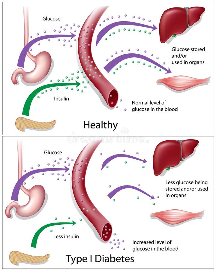 Type 2 diabetes stock vector. Illustration of diabetic - 29046584