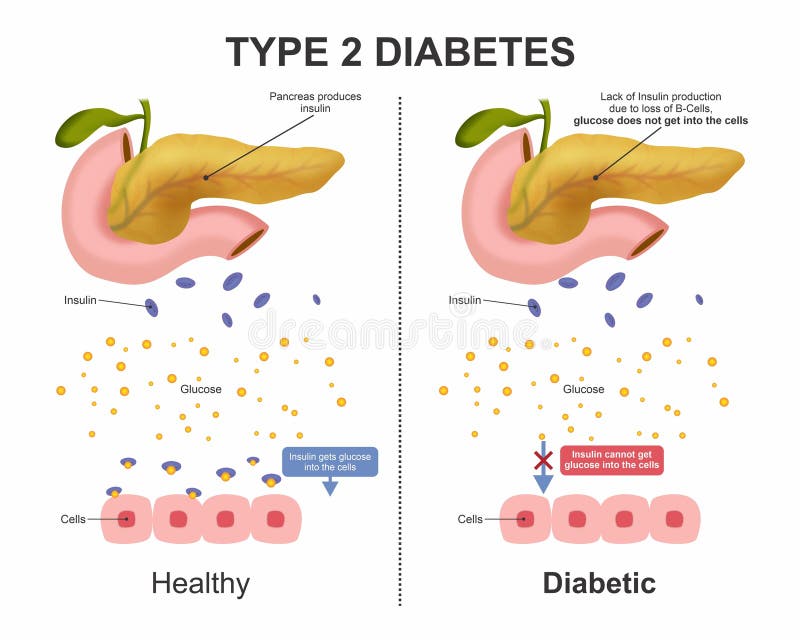 Type 2 Diabetes Difference between Healthy Vs Diabetic Stock ...