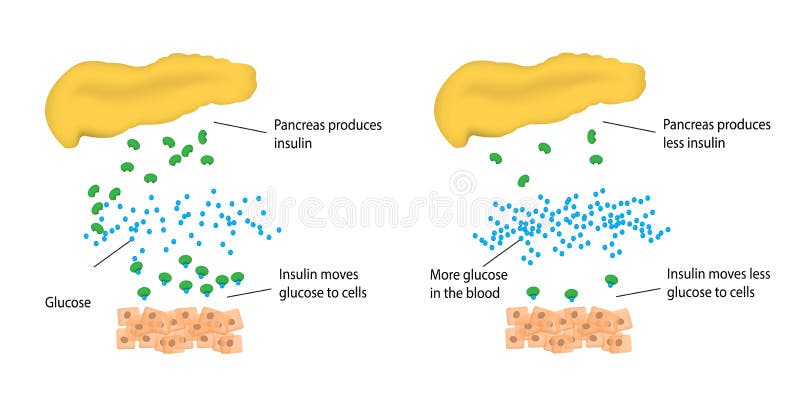 Type 2 diabetes stock vector. Illustration of diabetic - 29046584