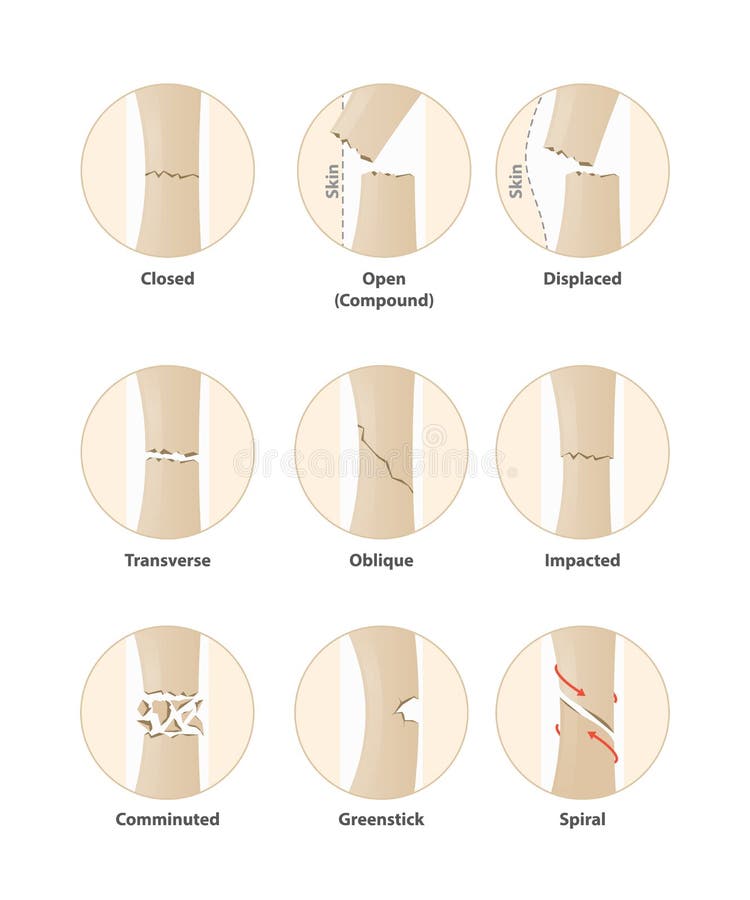 Types of Fracture. Fracture Bone Set. Infographics. Vector Illustration ...